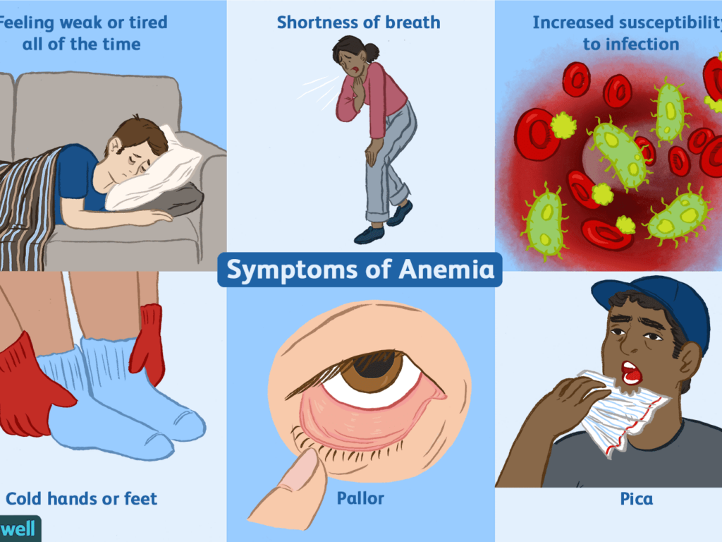 ANEMIJA - TOP 5 NAMIRNICA ZA LECENJE ANEMIJE ! - NUTRICIONISTA